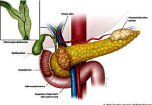 Pancreatic Cancer Prevention – Caribbean Cancer Portal